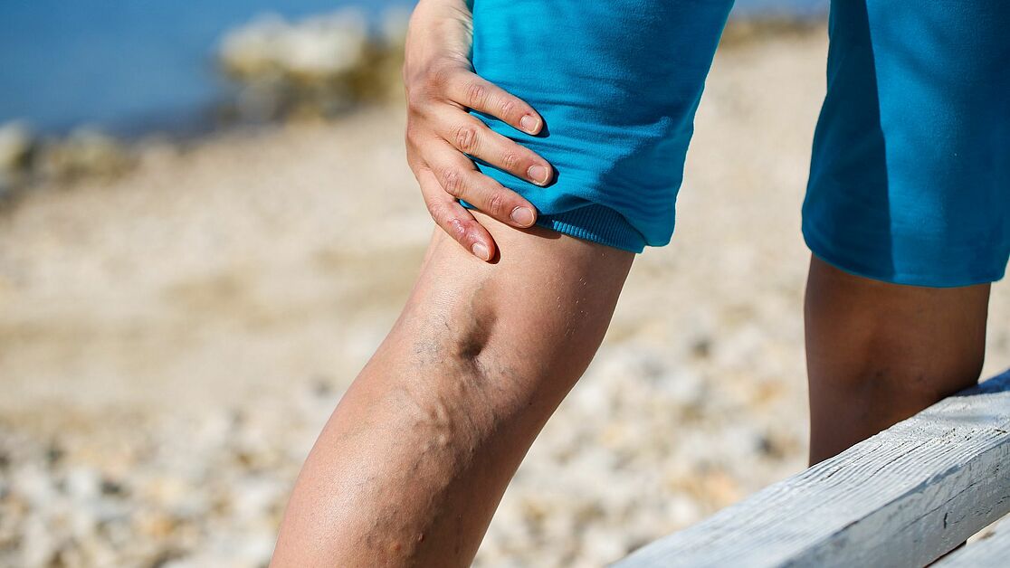 ¿Qué se puede hacer contra las varices (varices, varicosis)? | medi