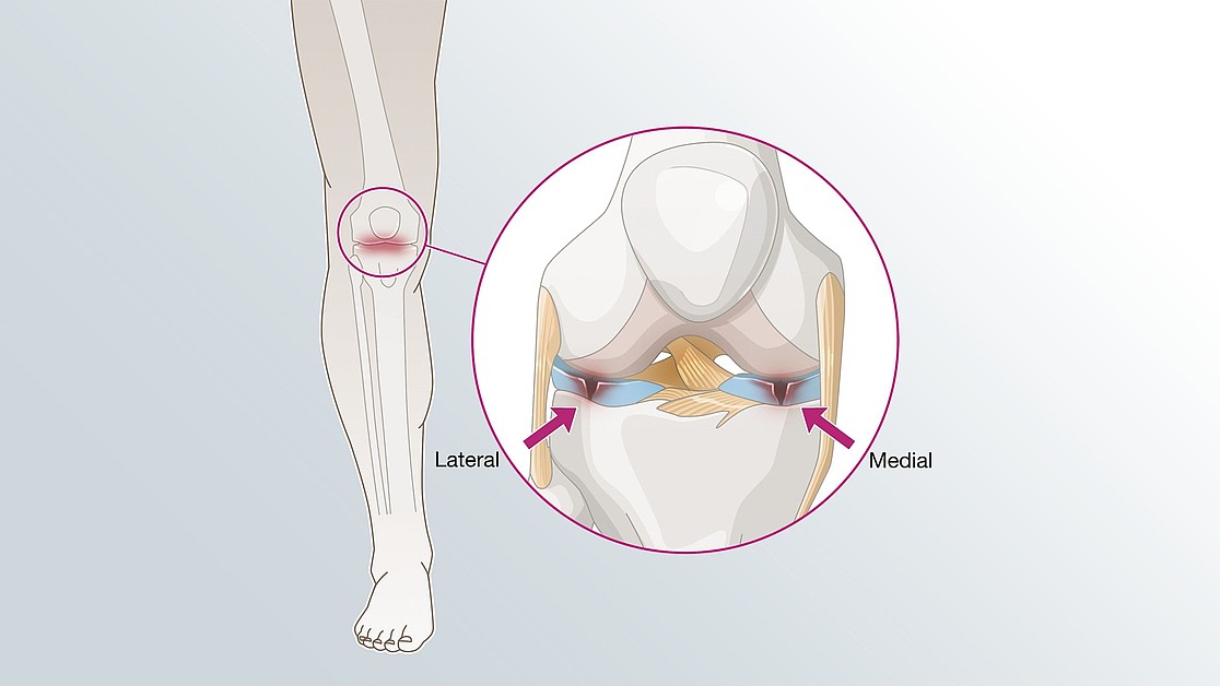 Lesiones de menisco: Tipos, causas, terapia | medi